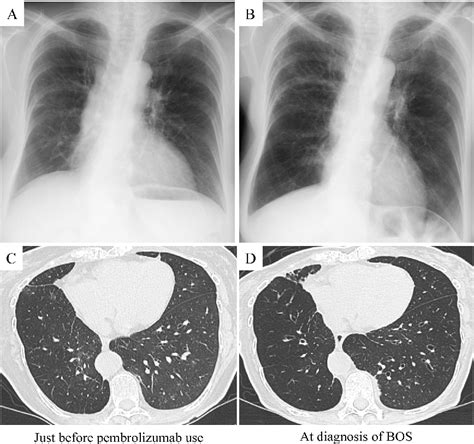 Bronchiolitis Obliterans Syndrome Associated With An Immune Checkpoint
