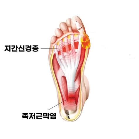 발바닥 앞쪽 아프면 족저근막염 아닌 이 병 당신의 건강가이드 헬스조선