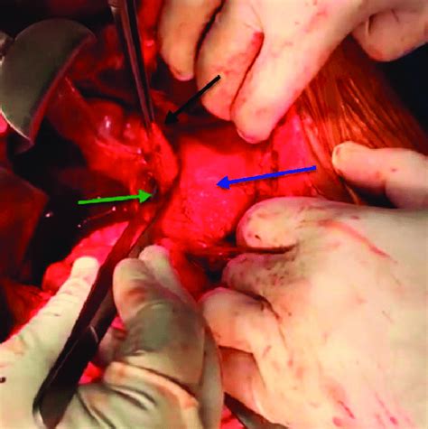 An Intraoperative Photo Showing The Kocherized Second Part Of The Download Scientific Diagram