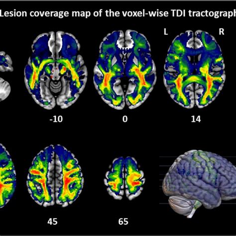 E Coverage Map Of The Voxel Wise Disconnections For Voxels With Download Scientific Diagram