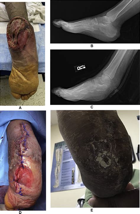 Outcomes In Patients With Heel Ulcerations That Underwent Below The