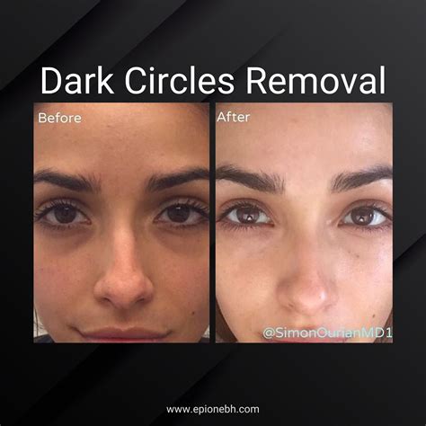 Dark Circles Under Eyes Treatment