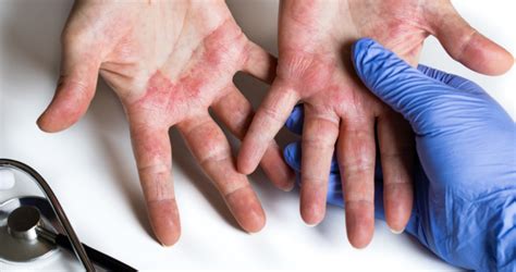 Atopic Dermatitis Vs Eczema Vujevich Dermatology