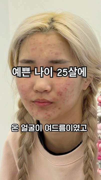 예쁜나이 25살에 여드름쟁이였던 나 여드름 여드름관리 여드름피부관리 여드름흉터 여드름피부 트러블 트러블피부 여드름박사 최츄츄 Youtube