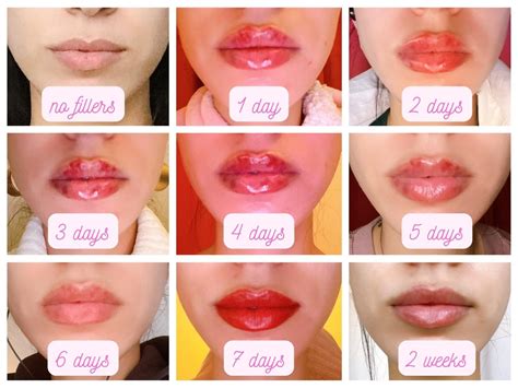 Lip Filler Healing Process Day By Day Yorkshire Skin Centre