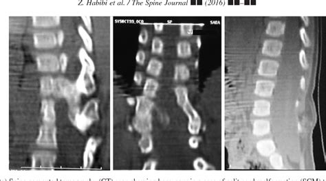 Figure 1 From Sacral Extradural Arachnoid Cyst In Association With Split Cord Malformation