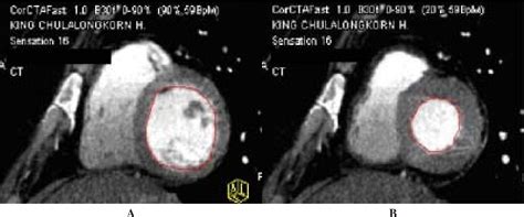 Figure 1 From Reliability Of The Evaluation For Left Ventricular Ejection Fraction By Ecg Gated