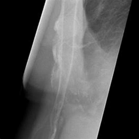 Example Of A Prominently Displaced Xiphoid Process On A Sagittal Image Download Scientific