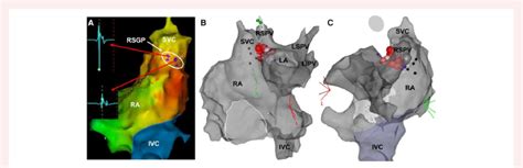 A A Posteroanterior View Of Three Dimensional Electroanatomical Download Scientific Diagram