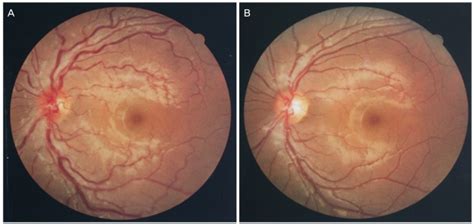 Venous Stasis Retinopathy