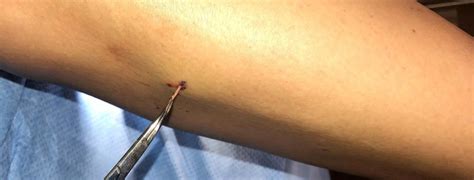 Venous And Lymphatic Medicine Sports Medicine Dr Darling Do Rvt Rpvi