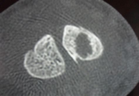 Transverse Ct Scan Confirmed A Cystic Lesion Of The Scaphoid And Was Download Scientific