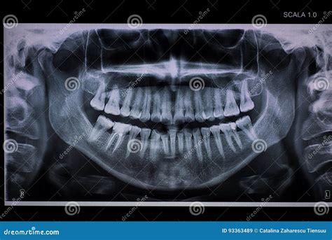 Panoramic Dental Xray With A Root Canal Stock Image Image Of Patient