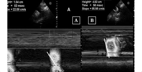 Measurement Of Descending Aorta Propagation Velocity Avp In A Download Scientific Diagram