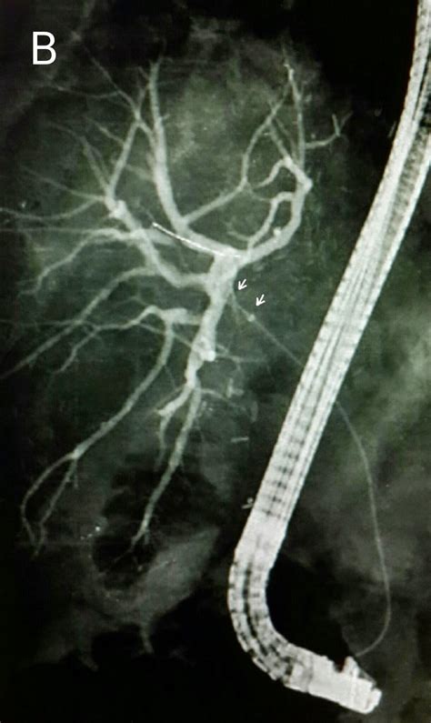 ERCP EGD Fourth Follow Up ERCP For Post Lover Transplant Anastomotic Stricture CASE A