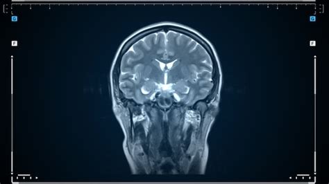 Mri Scan Van Een Menselijk Brein In Beweging Scannen Van Het Beeld Van