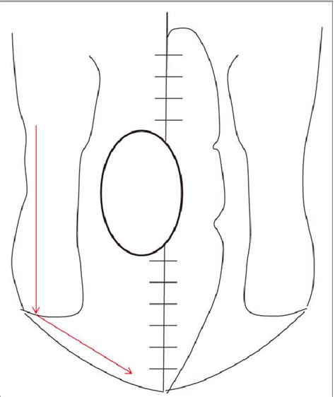 A Skin Incision Is Made On The Right Midaxillary Line And An Obliquus