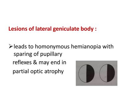 Visual Pathway And Its Lesions Pptx