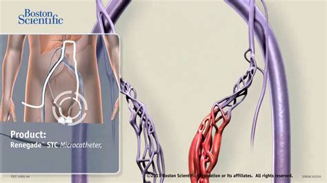 Varicocele Perth Vascular Clinic