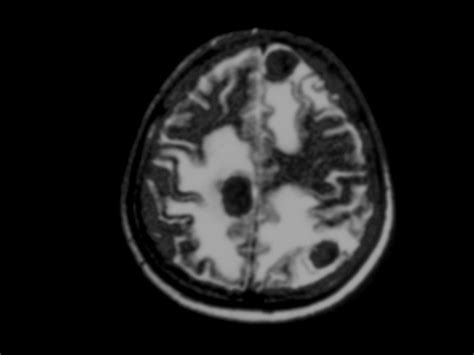 Magnetic Resonance Imaging Findings Of Cerebral Echinococcus Alveolaris