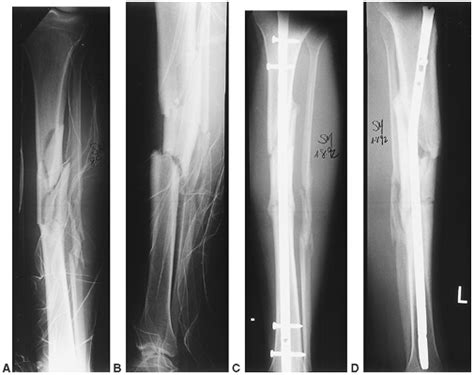 Fractures Of The Tibia TeachMe Orthopedics