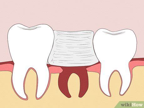 Dry Socket Symptoms Proven Treatments Safe Foods Prevention