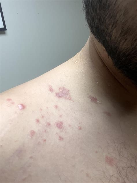 Is This Pityriasis Rosea Rskincareaddiction