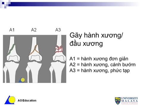Ao Fracture Classification V Nese PPT