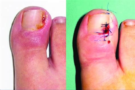 Partial Avulsion Followed By Chemical Matricectomy Using 88 Phenol