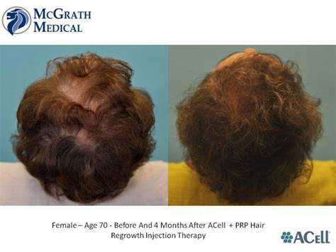 Acell Prp Hair Regrowth Injection Therapy For Women In Austin Texas Tx