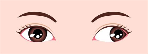 What Is Exotropia Types Symptoms Signs And Diagnosis