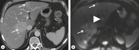 Colorectal Liver Metastases Clinical Tree