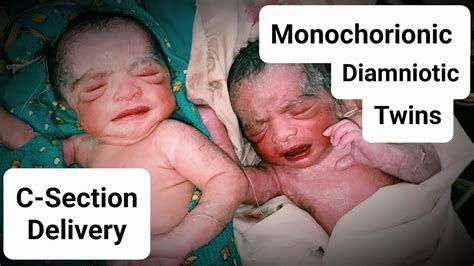 Twins C Section Monochorionic Diamniotic Twins Dr Tayyab Riaz Ch Youtube