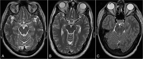 Figure 1 From Diagnosis Of Intracranial Hypotension On Objective Marker For The Detection And