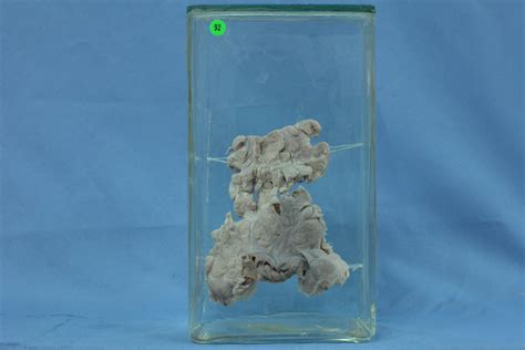 结核 93 92 肠系膜淋巴结结核病理标本博物馆 复旦大学基础医学院