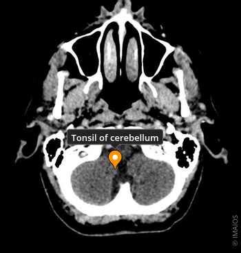 Tonsil Of Cerebellum E Anatomy Imaios