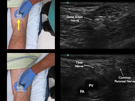 Popliteal Block