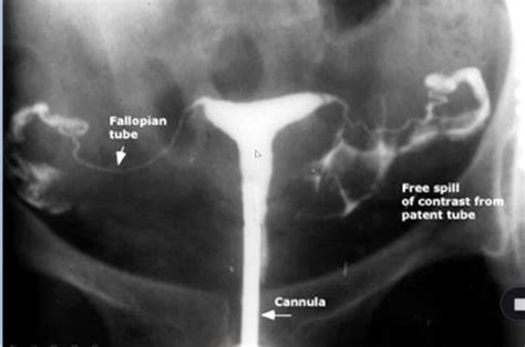 Reproductive Imaging Flashcards Quizlet