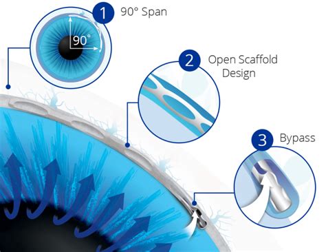 Hydrus® Microstent Myalcon Base