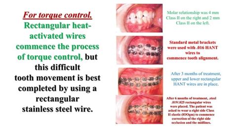MBT Wire Sequence During Orthodontic Alignment And Leveling PPTX Dental Health Diseases