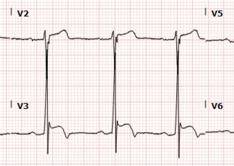 2 Early Repolarization Variants Funky St T Segments To Learn And Save
