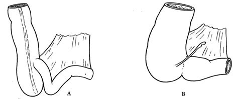 Paper Appendix Vermiformis Duplex 1936 Embryology