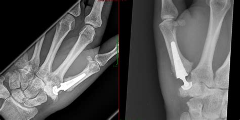 Bilateral Thumb Base Joint Replacement Durham Hand Clinic