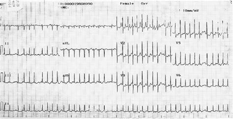 Electrocardiogram Of The Neonate After Birth Prior To Treatment Shows Download Scientific
