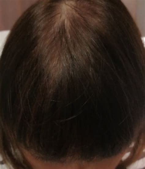 Best Folix Hair Restoration In Seattle Root Hair Institute