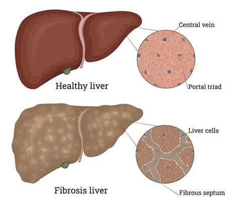 Fibrosis Hepática