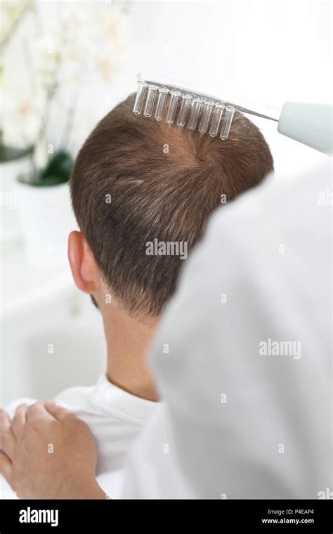Needle Mesotherapy Of The Scalp Microneedle Mesotherapy Of The Scalp The Head Of A Man With