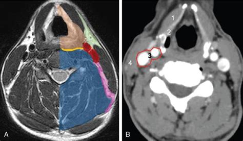 Carotid Space Radiology Key