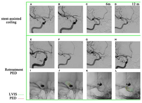 Frontiers Retreatment With A Pipeline Embolization Device For Recanalized Aneurysms Following