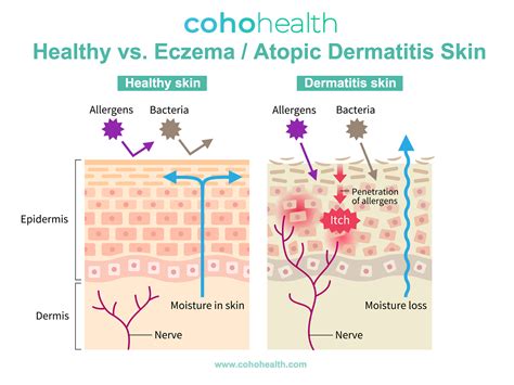 Can A Functional Medicine Approach To Eczema Help You